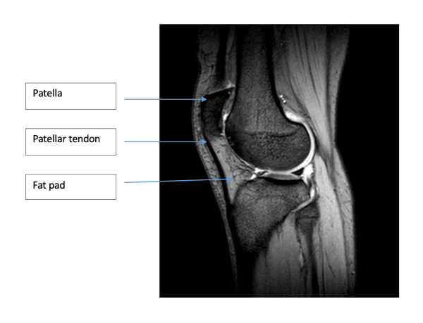 Hoffas Fat Pad Impingement Knee Cap Surgeon London Expert Knee Clinic